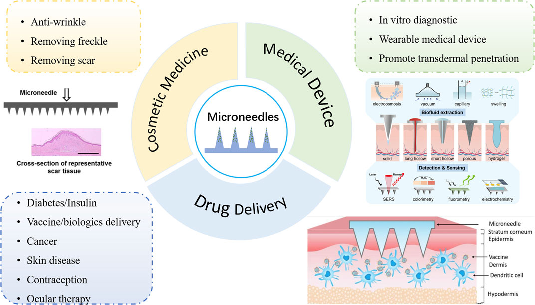 Frontiers Publishing Partnerships | Recent progress of polymeric microneedle-assisted long ...