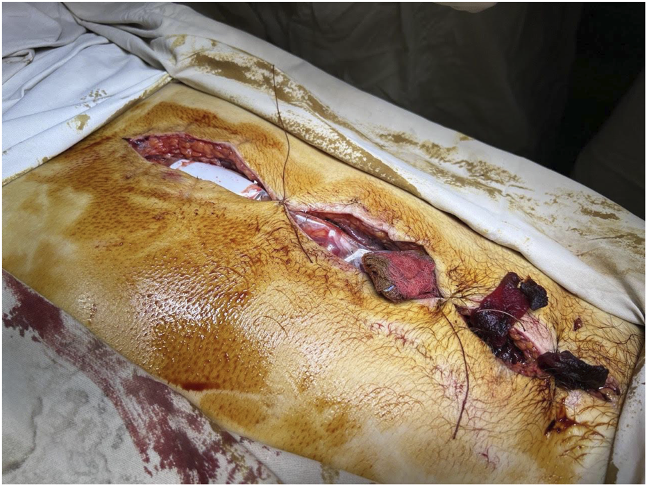 Frontiers Publishing Partnerships | Implementation of Modified Enhanced ...